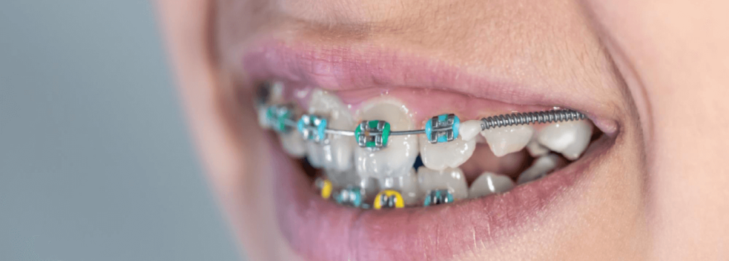 What is a Neuromuscular Silensor?